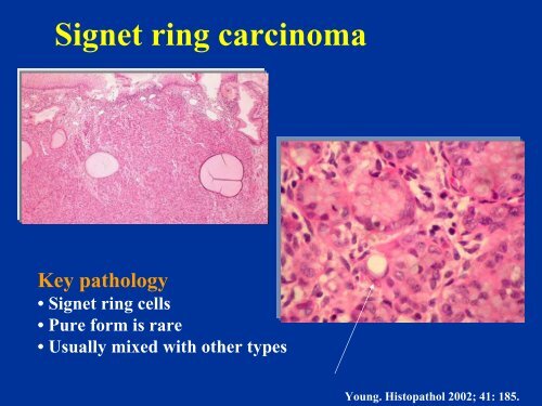 Signet ring carcinoma Key