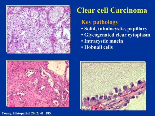 Clear cell Carcinoma