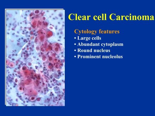 Clear cell Carcinoma