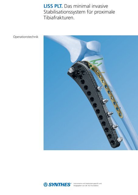 LISS PLT. Das minimal invasive Stabilisationssystem für ... - Synthes