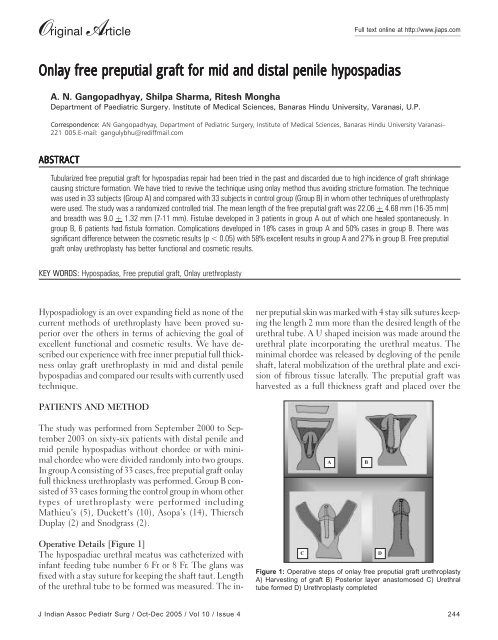 Onlay free preputial graft for mid and distal penile hypospadias