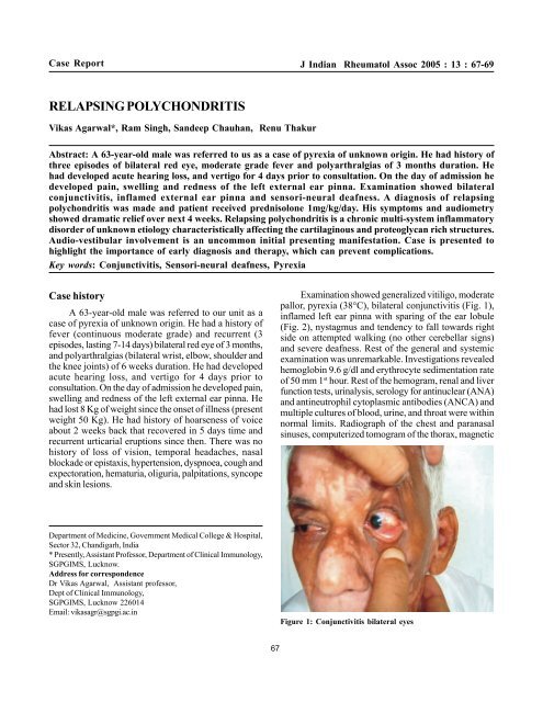 RELAPSING POLYCHONDRITIS - medIND